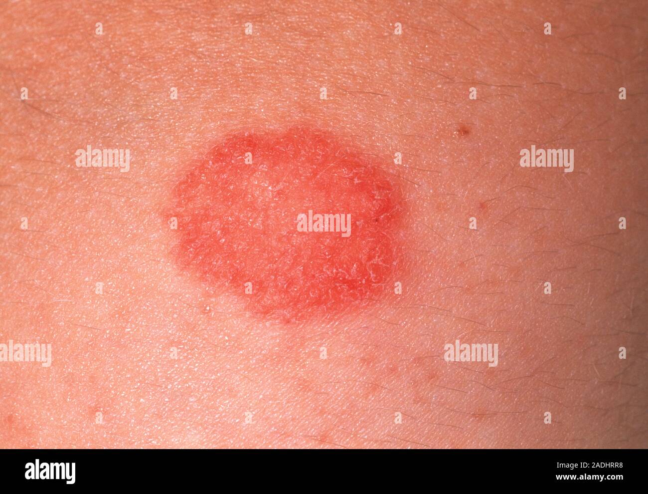 Photosensitive drug reaction on the skin of an 82- year-old woman. The ...