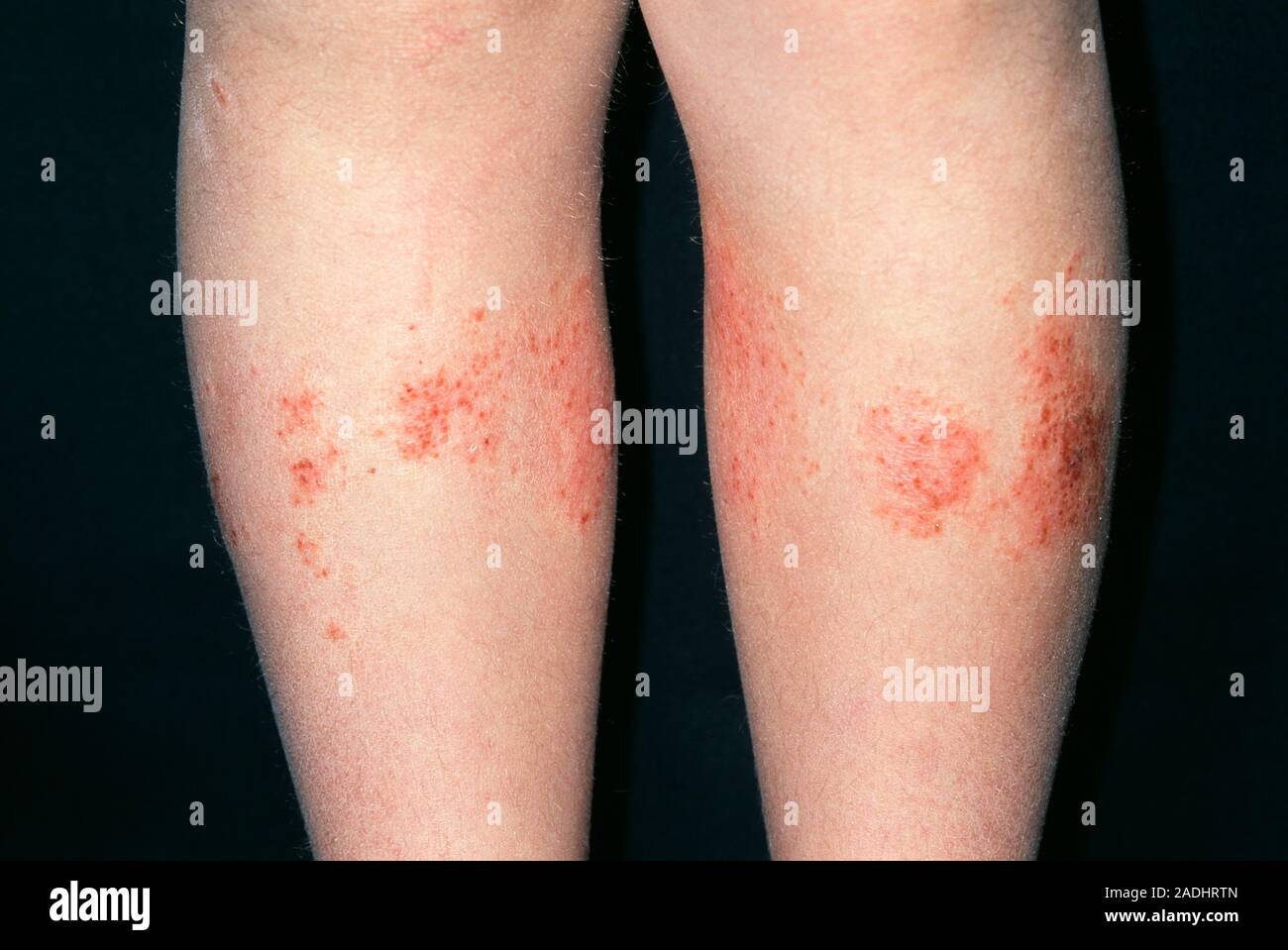 Eczema On Shins