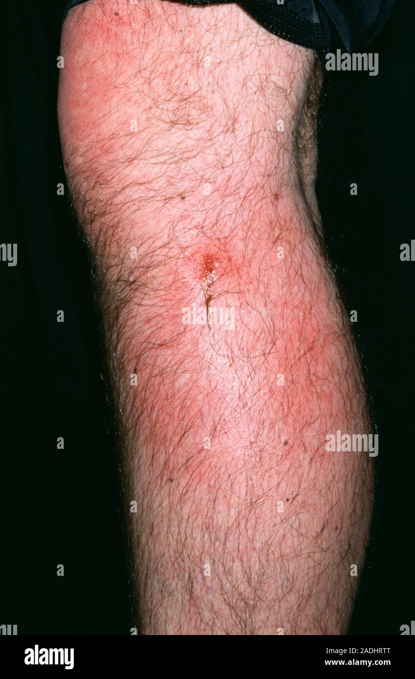 Bee Sting Leg Swelling