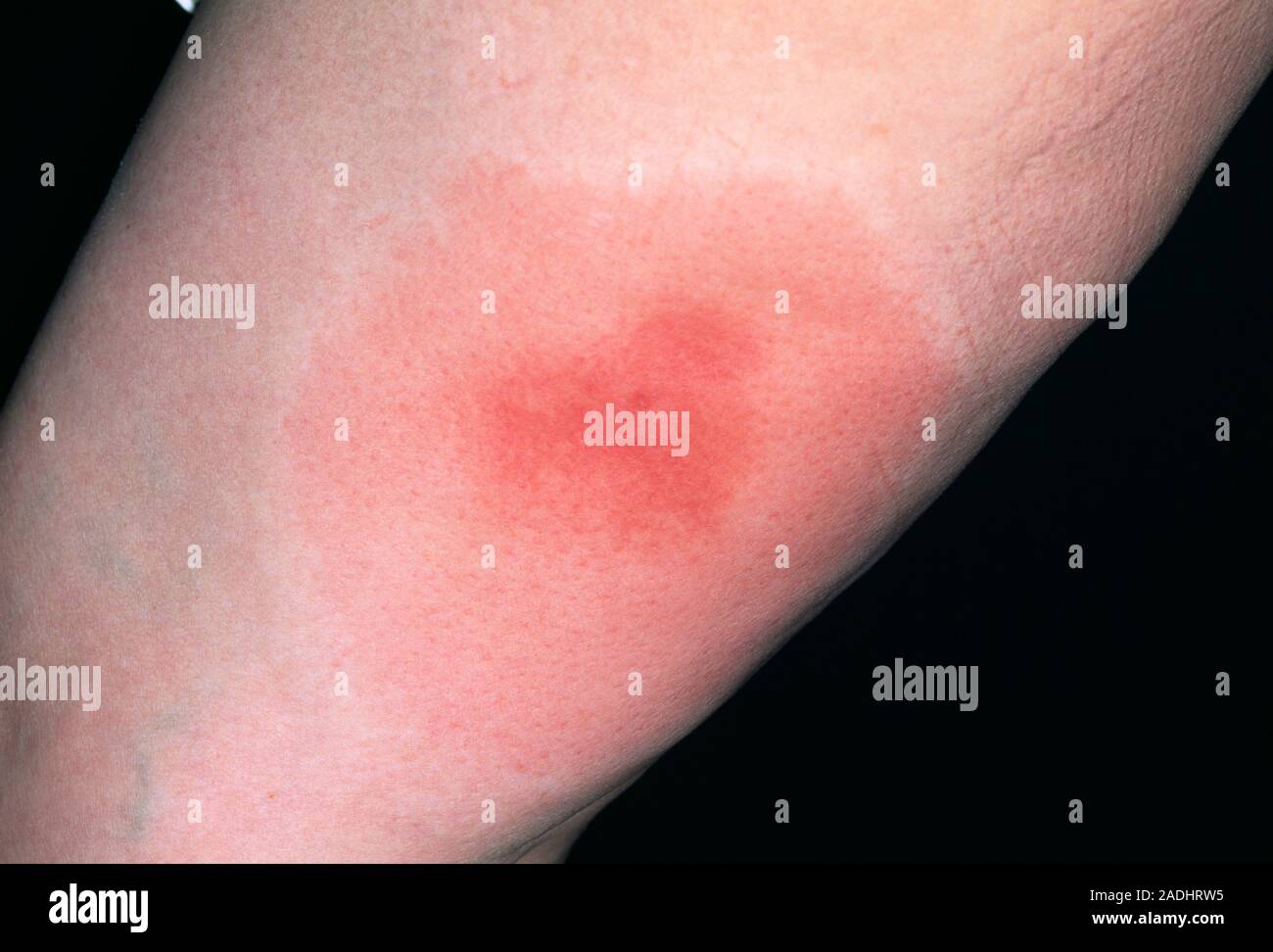 Infected bee sting on the skin of a 55-year-old woman. The red swollen ...