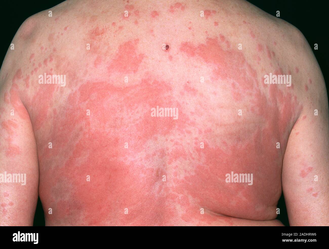 Penicillin allergy. Urticaria rash on the back of an 80-year-old man ...