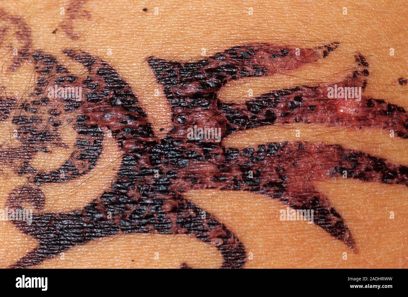 Allergic reaction to a henna tattoo on the skin of a 14-year-old girl ...