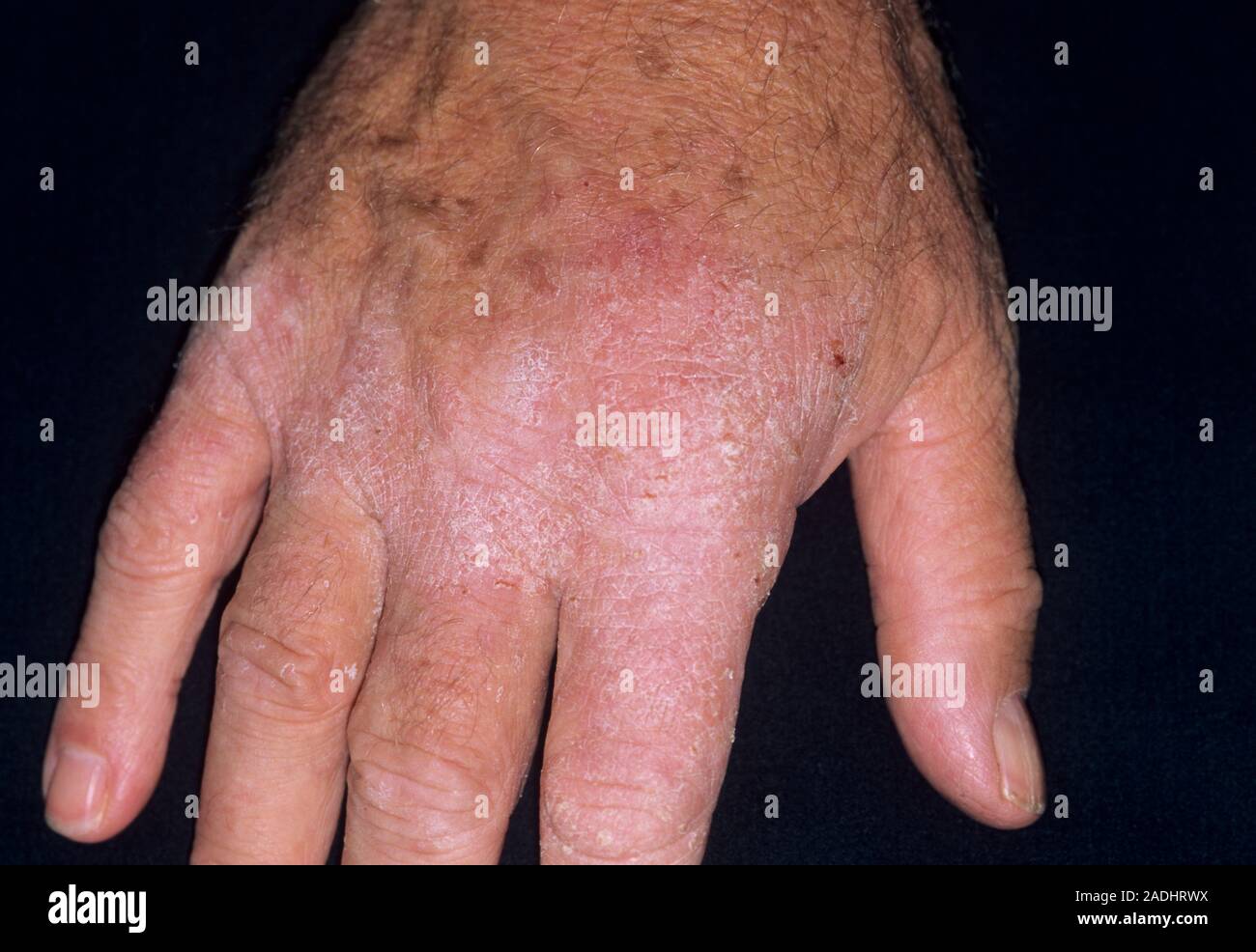 Allergic reaction. Dry scaly skin on the hand of 68-year-old man caused ...