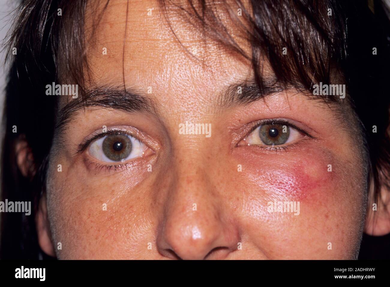 MODEL RELEASED. Wasp sting. Swelling under the eye of a 41-year- old ...
