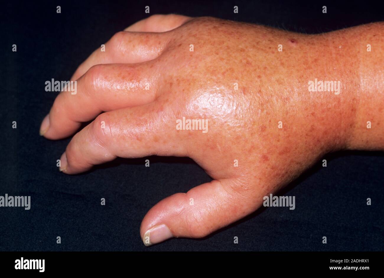 Wasp sting. Swollen hand of a 61-year-old woman caused by a wasp sting. The venom in wasp stings ...