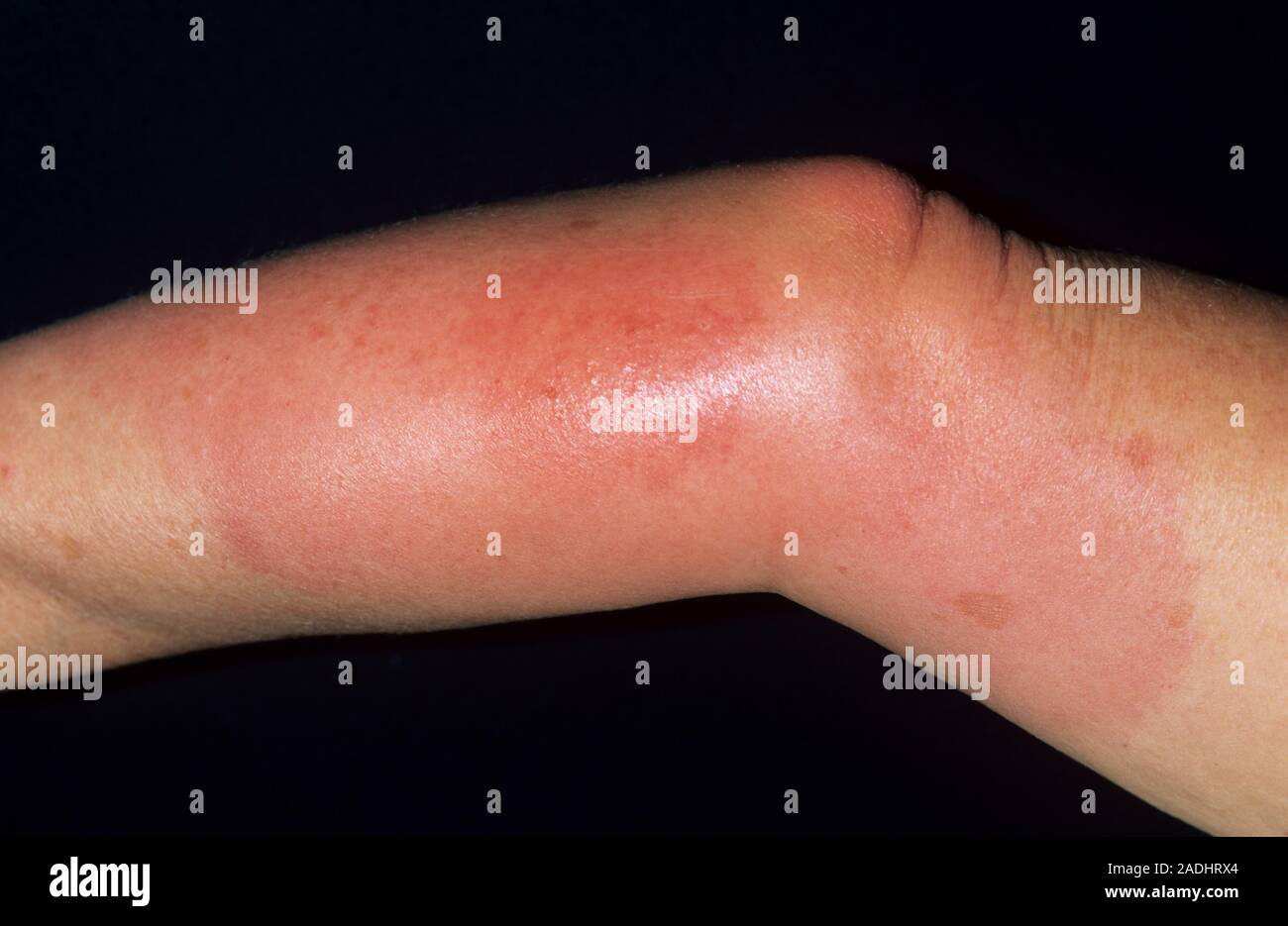 Wasp sting. Swollen forearm of a 64-year-old woman 2 days after she was ...
