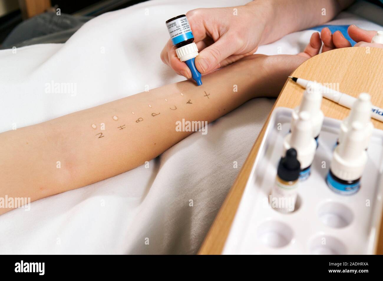 Allergy test. Arm of a 10-year-old boy undergoing a skin scratch ...
