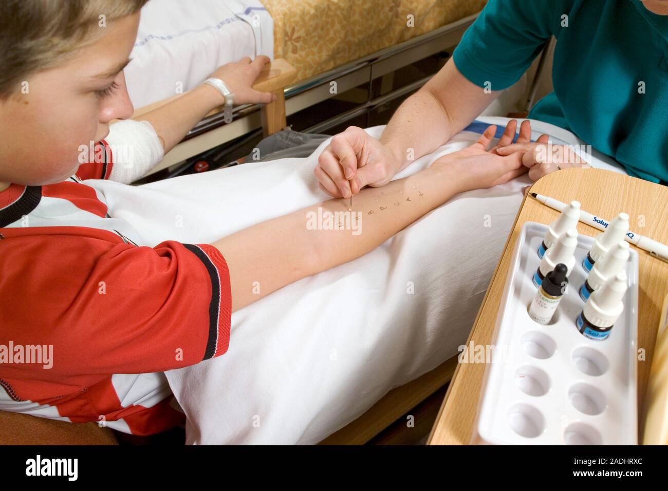 MODEL RELEASED. Allergy test. Arm of a 10-year-old boy undergoing a ...