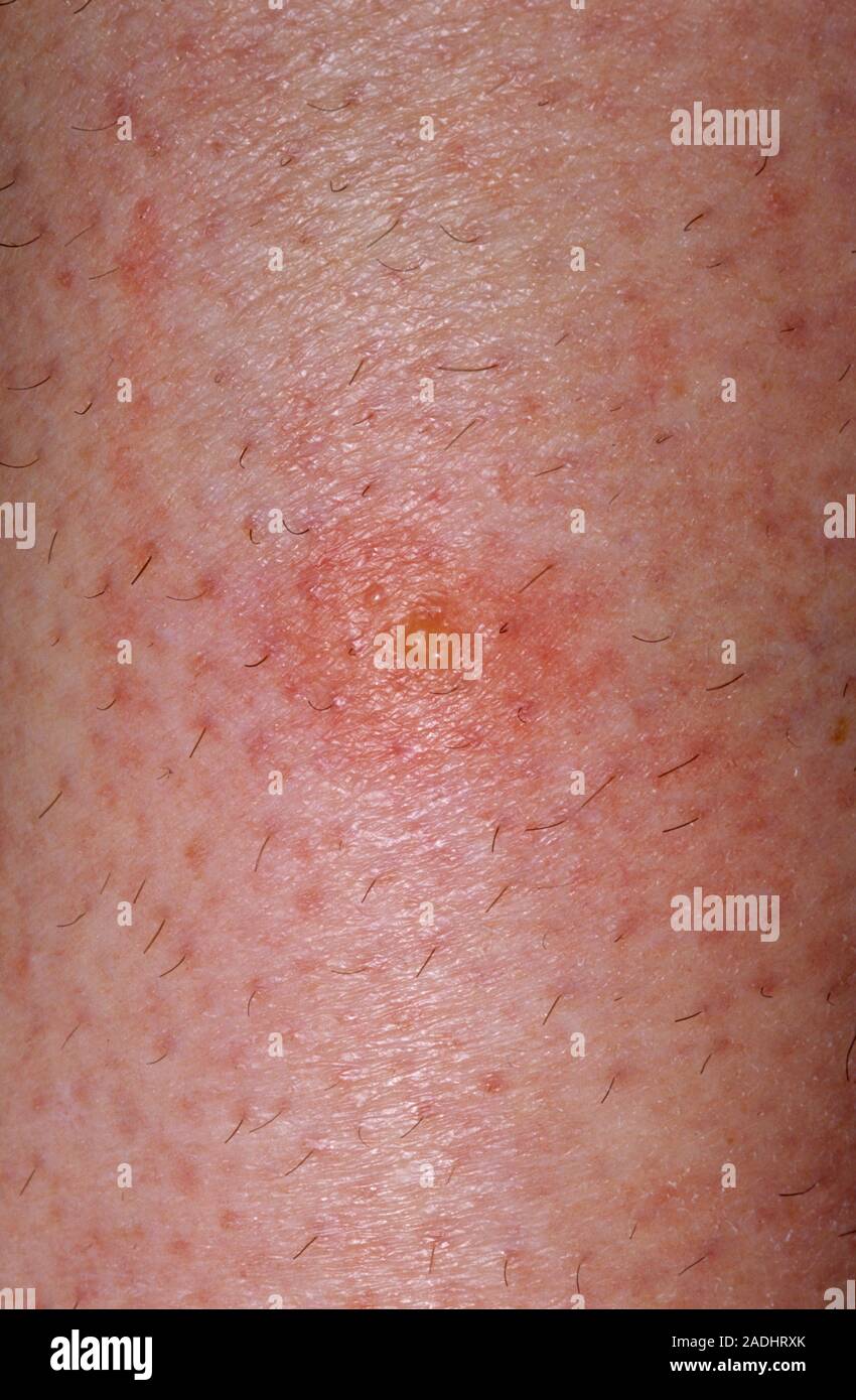 Insect bite on a patient's ankle. A blister has formed at the site of ...