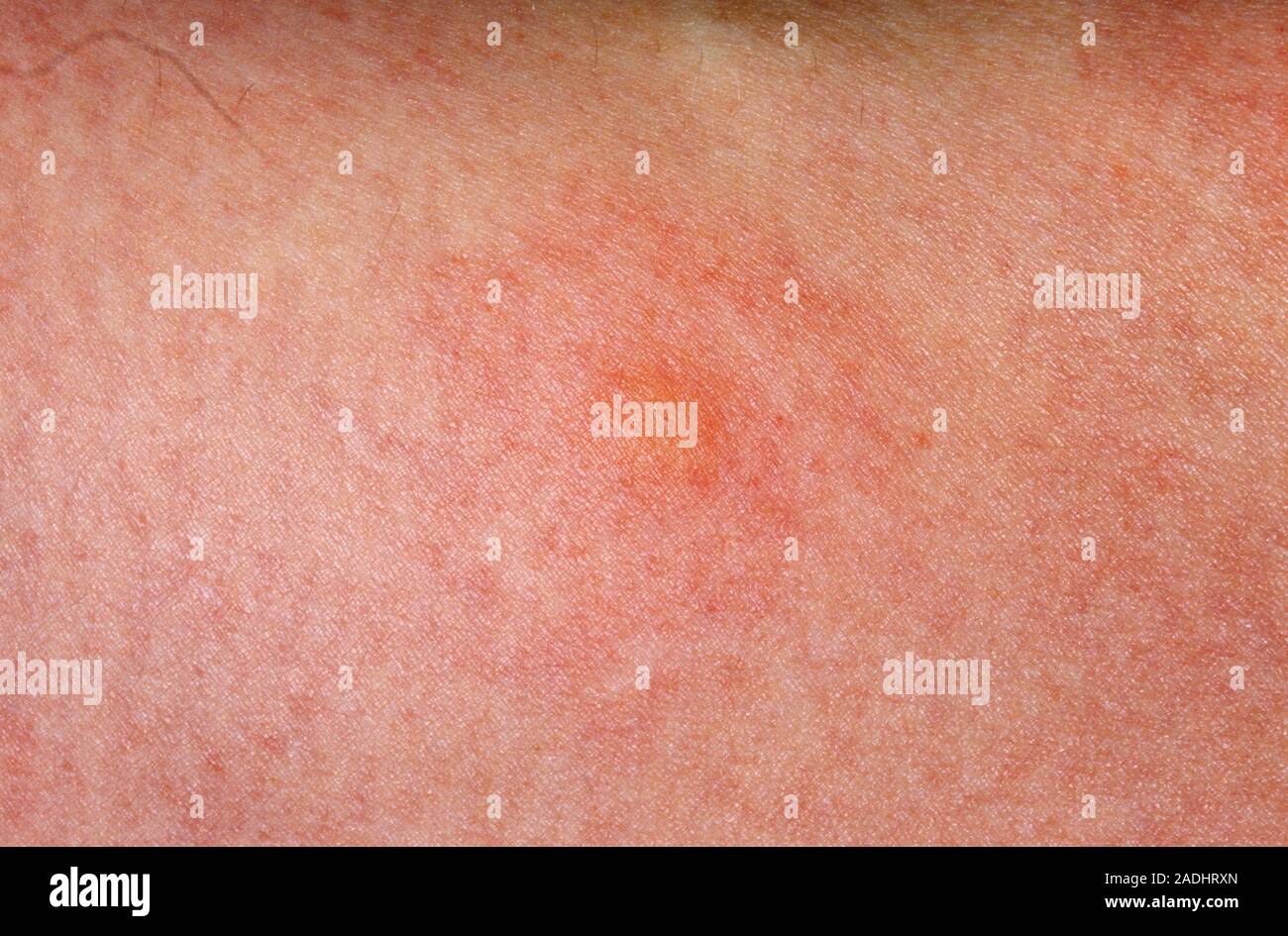 Insect bite, day 2. Image 2 of 3. Patient with an insect bite on their ...