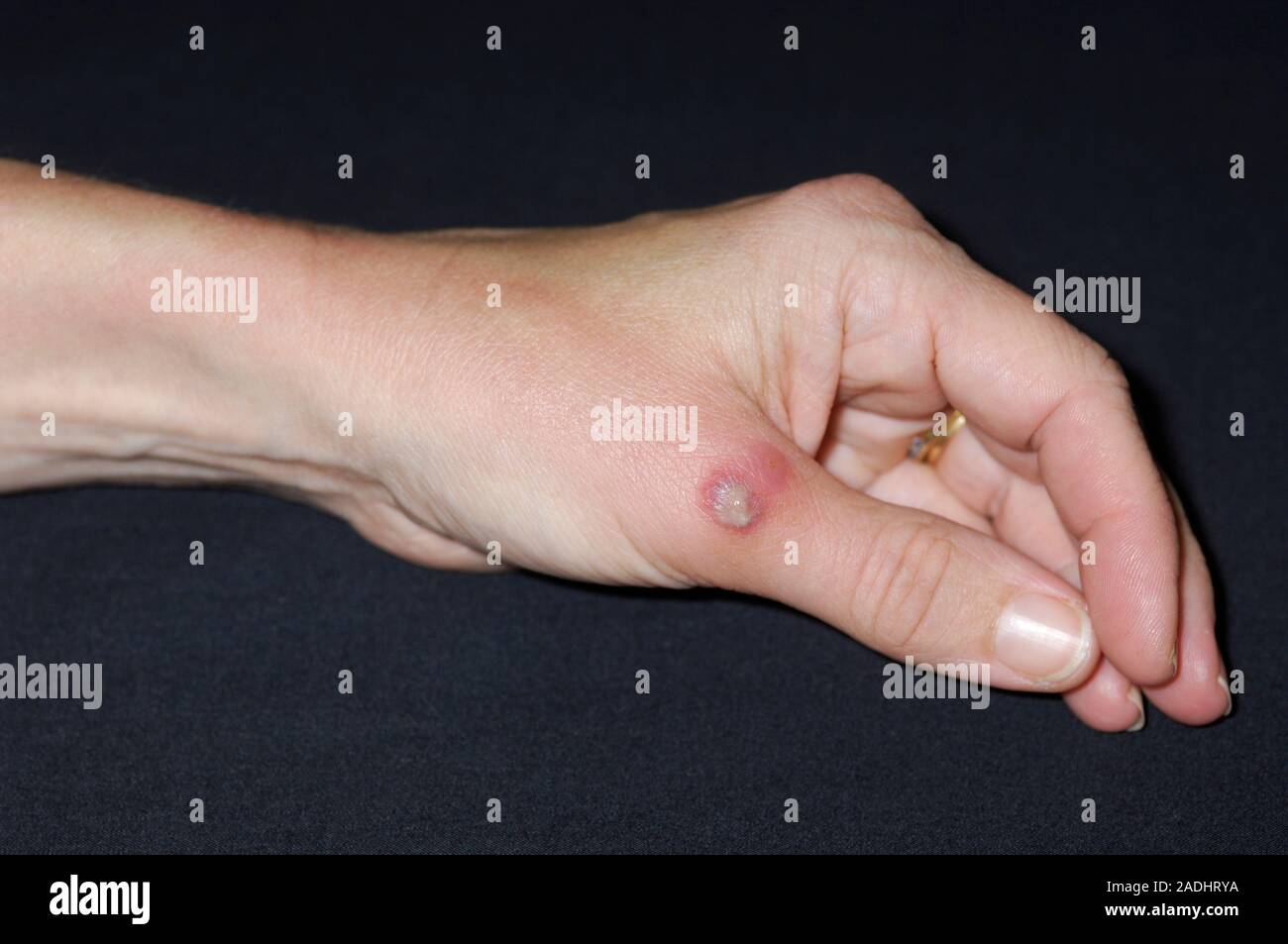 Insect bite on the thumb of a 44 year old woman. The bite has become ...
