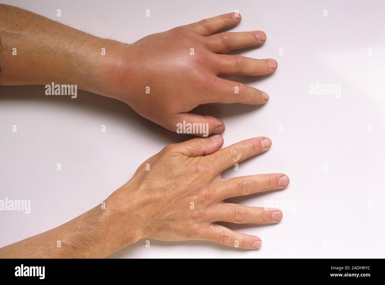 Wasp sting reaction. Swollen hand of a 43 year old man next to his other unaffected hand. The ...
