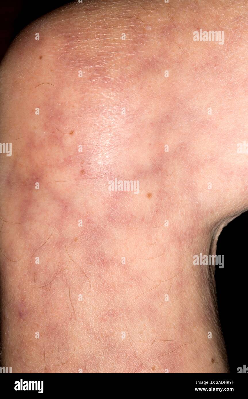Livedo reticularis disorder affecting the blood vessels (dark red ...