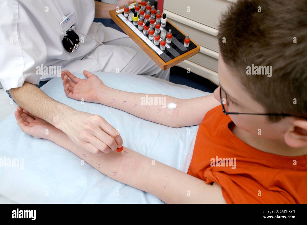 MODEL RELEASED. Allergy test. Eleven year old boy undergoing a skin ...