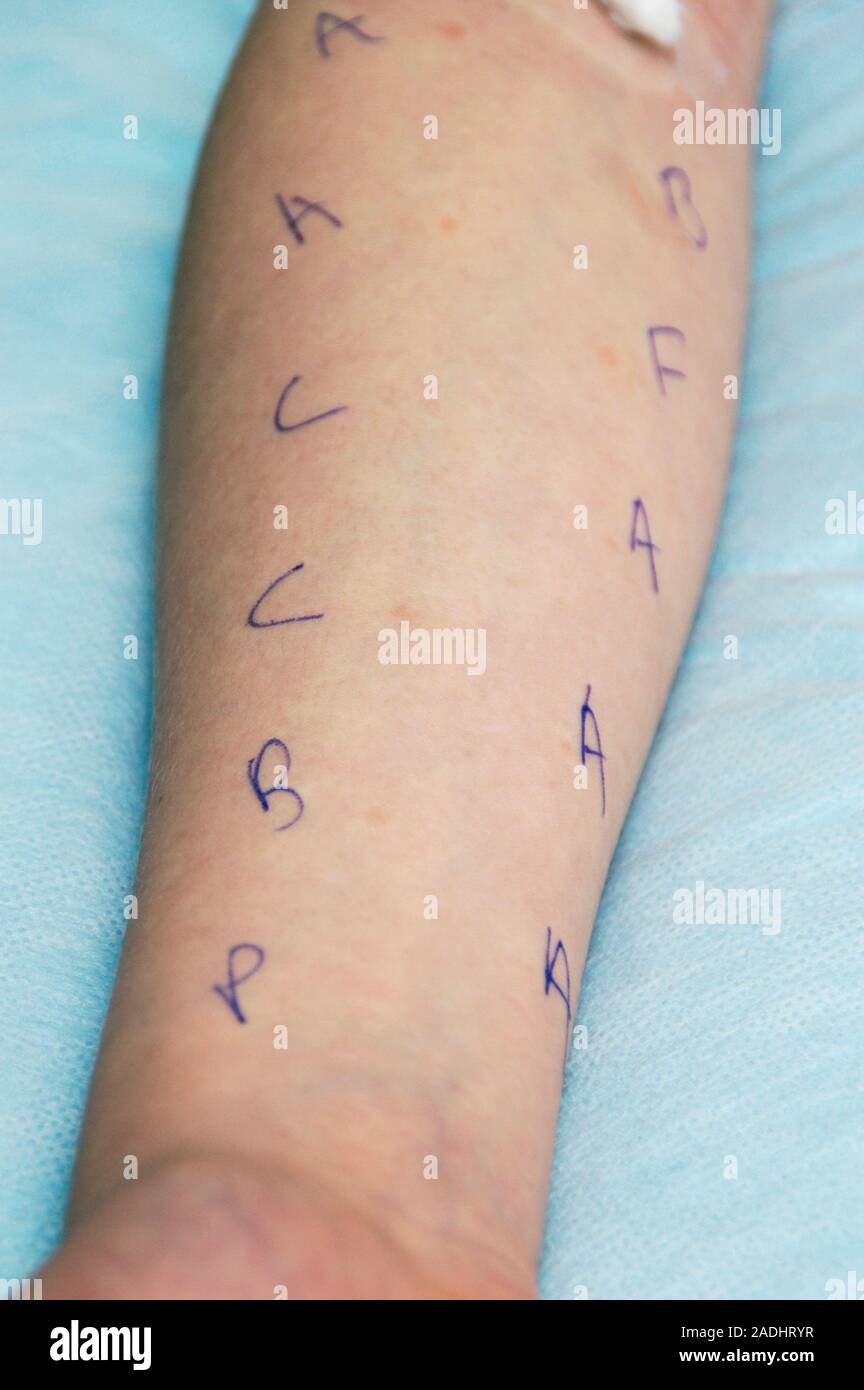MODEL RELEASED. Allergy test. Arm of an eleven year old boy undergoing ...