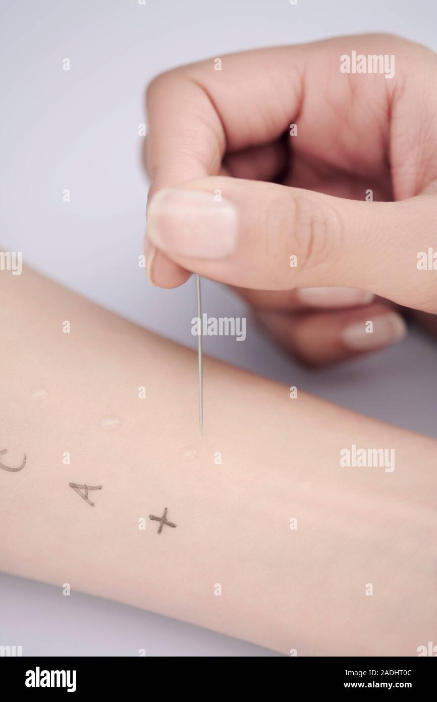 MODEL RELEASED. Allergy test. Arm of a twenty five year old woman ...