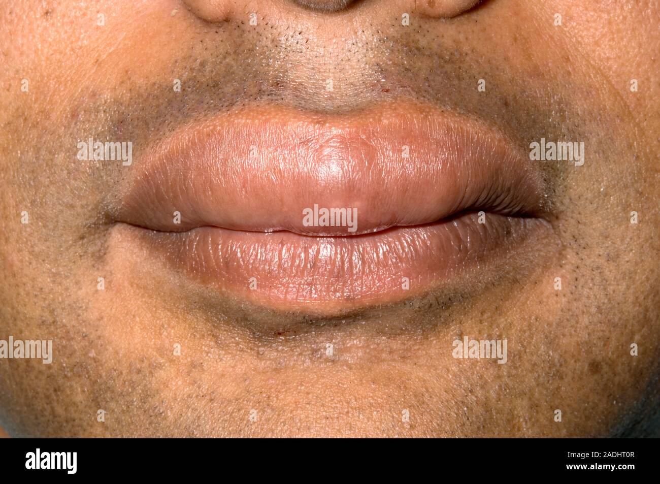 MODEL RELEASED. Swollen lip of a 40 year old man caused by angioedema ...