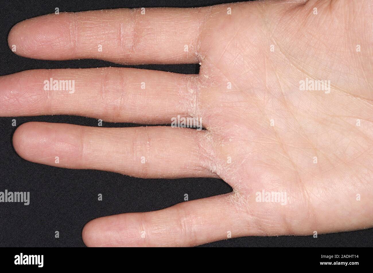 Contact dermatitis on the hand of a 26 year old woman, which developed ...