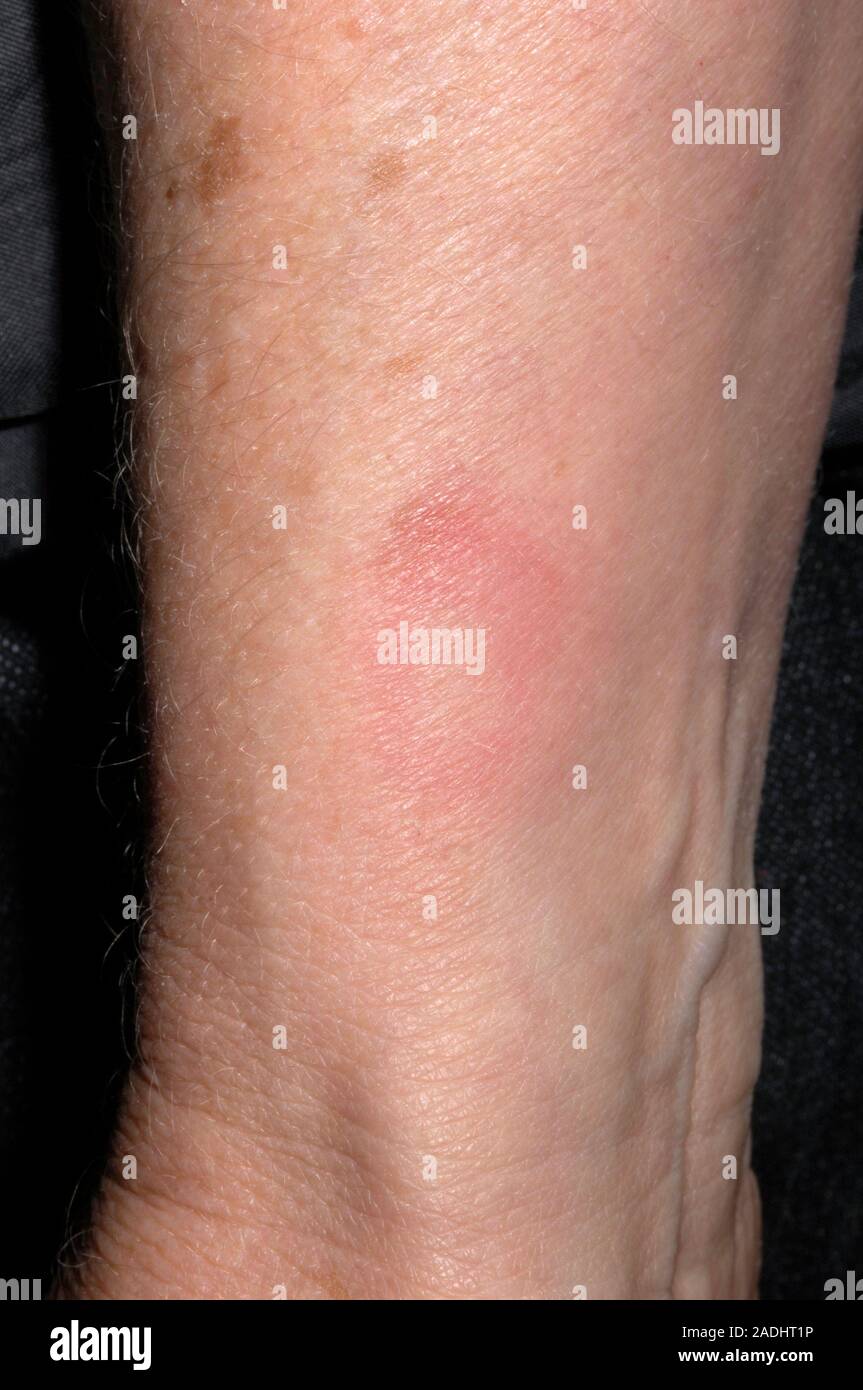 Drug-induced rash on the skin of a 60-year-old woman's wrist. Drug ...