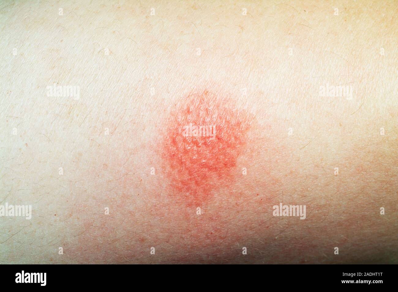 Mosquito bite on an arm. When a mosquito bites a human it injects ...