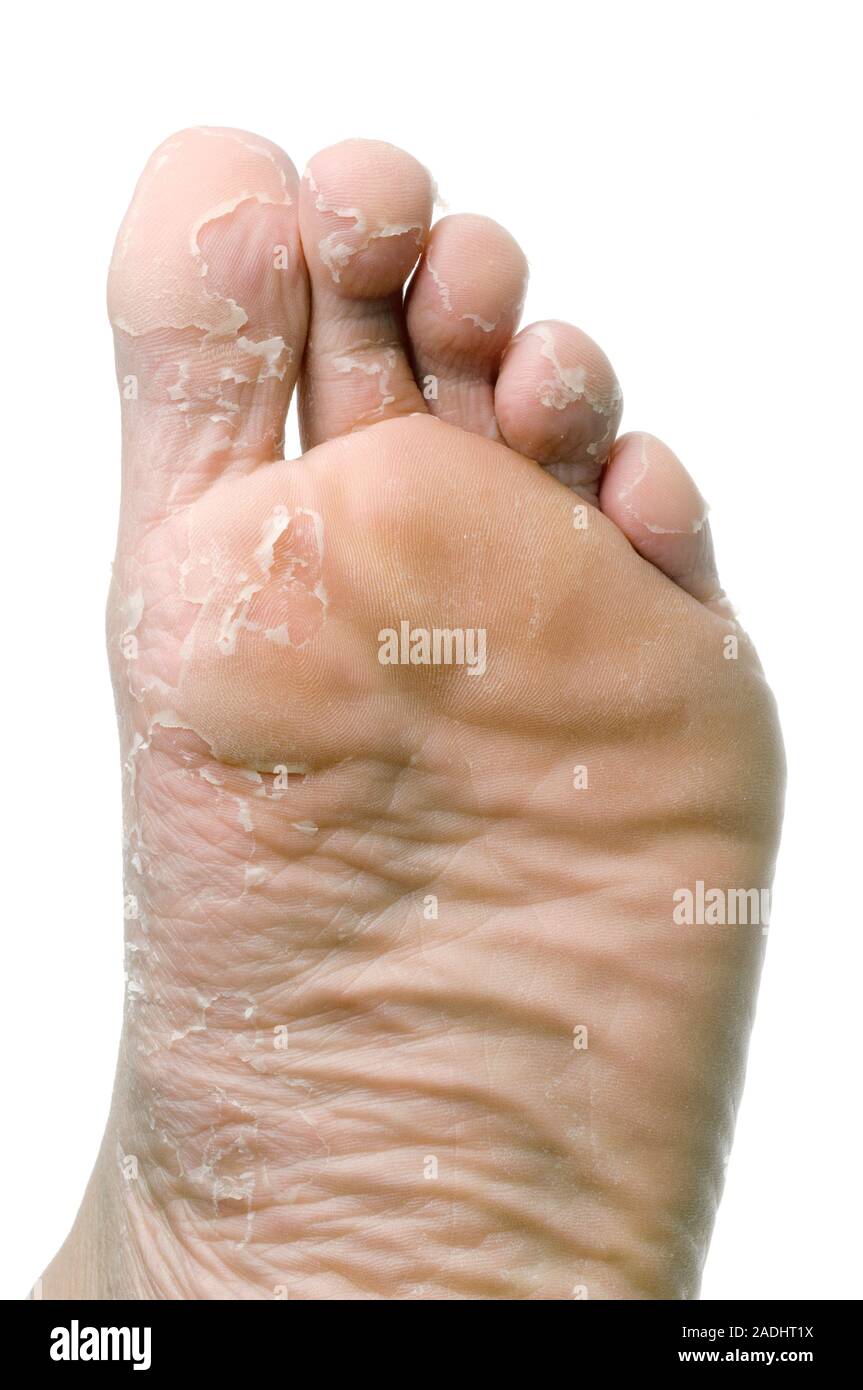 Allergic reaction. Skin peeling on a patient's foot after an allergic ...
