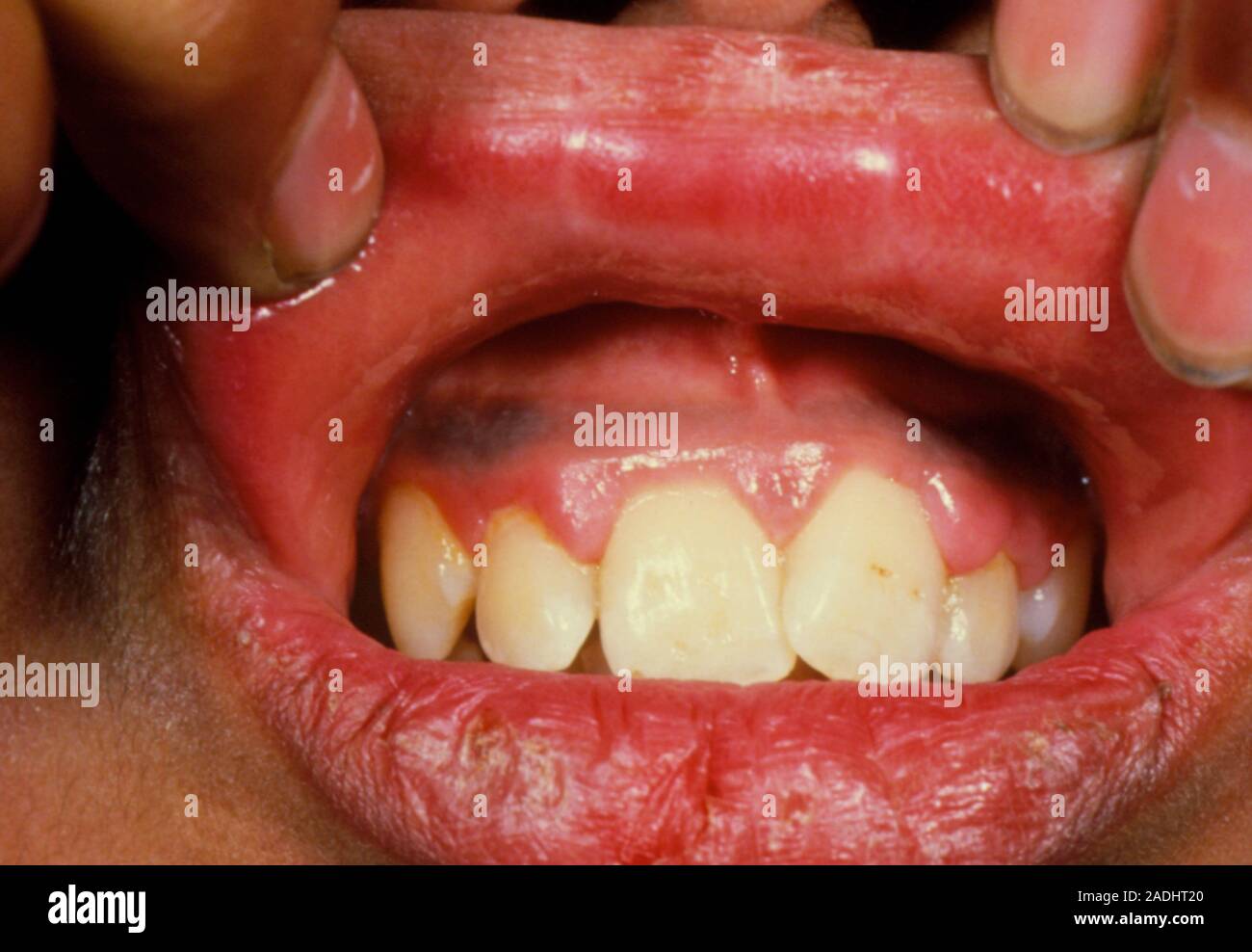 Lead poisoning. Dark deposits of lead sulphate (known as lead lines) on ...