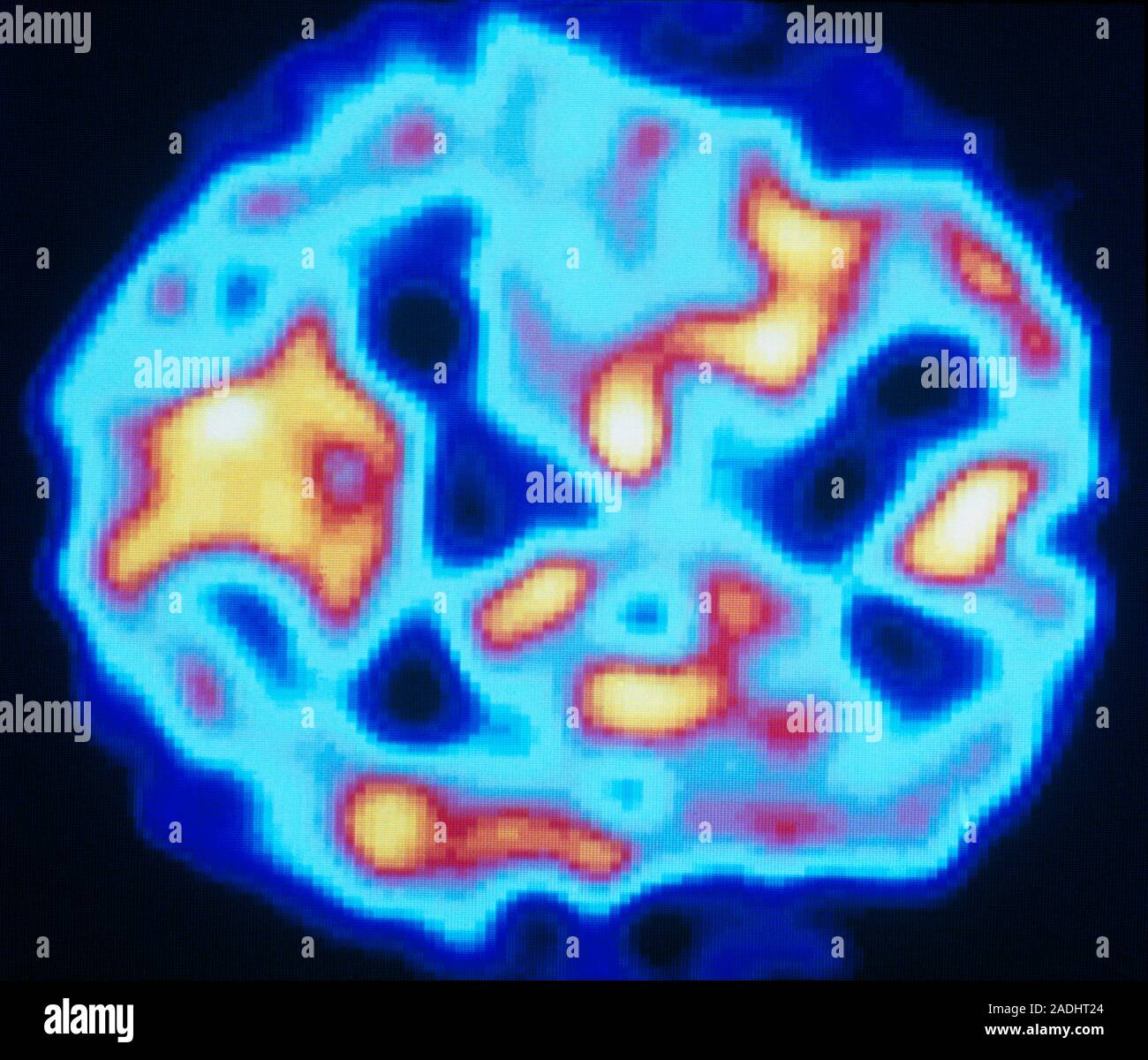 Positron emission tomography (PET) scan of the brain (temporal lobe ...