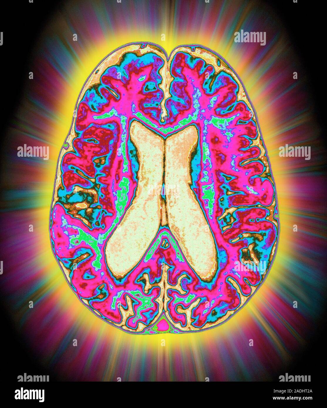 Organophosphate brain damage. Coloured magnetic resonance imaging (MRI) scan of a man's brain ...