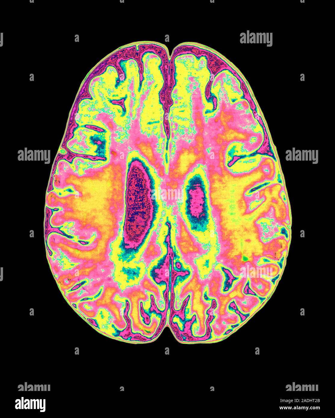 Organophosphate brain damage. Coloured magnetic resonance imaging (MRI) scan of a man's brain ...
