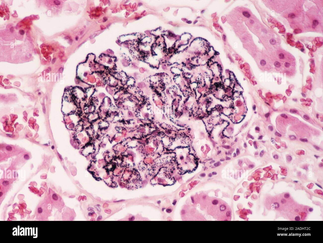Silver poisoning. Light micrograph of a section through a glomerulus ...