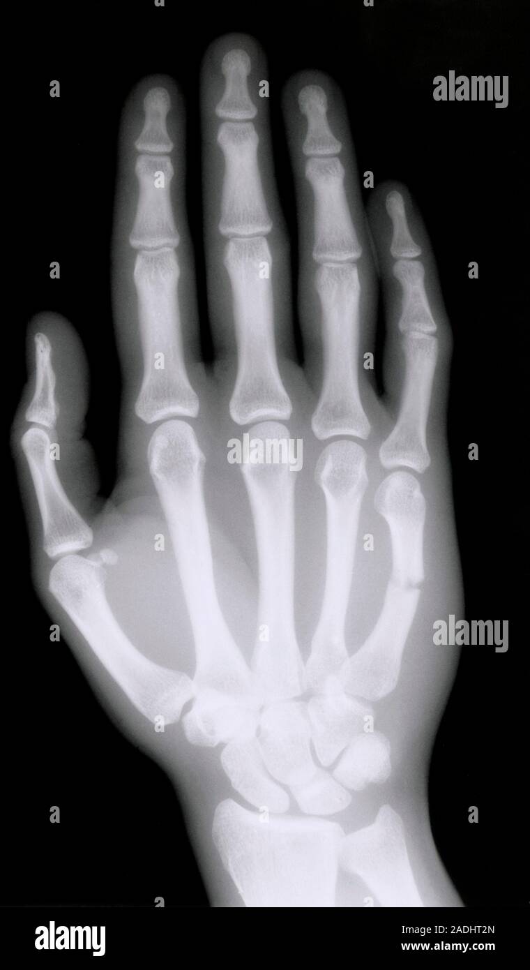X Ray Of A Broken Metacarpal Finger Joint Nearest The Wrist Bones Or