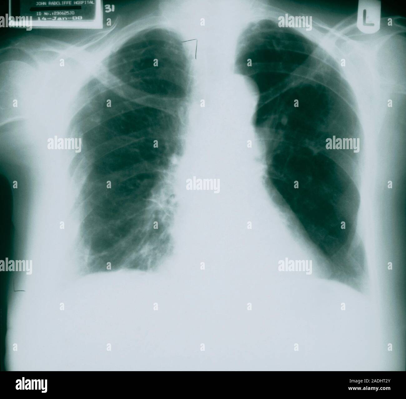 X-ray of fractured ribs on the right side of the body. Four cracked ...