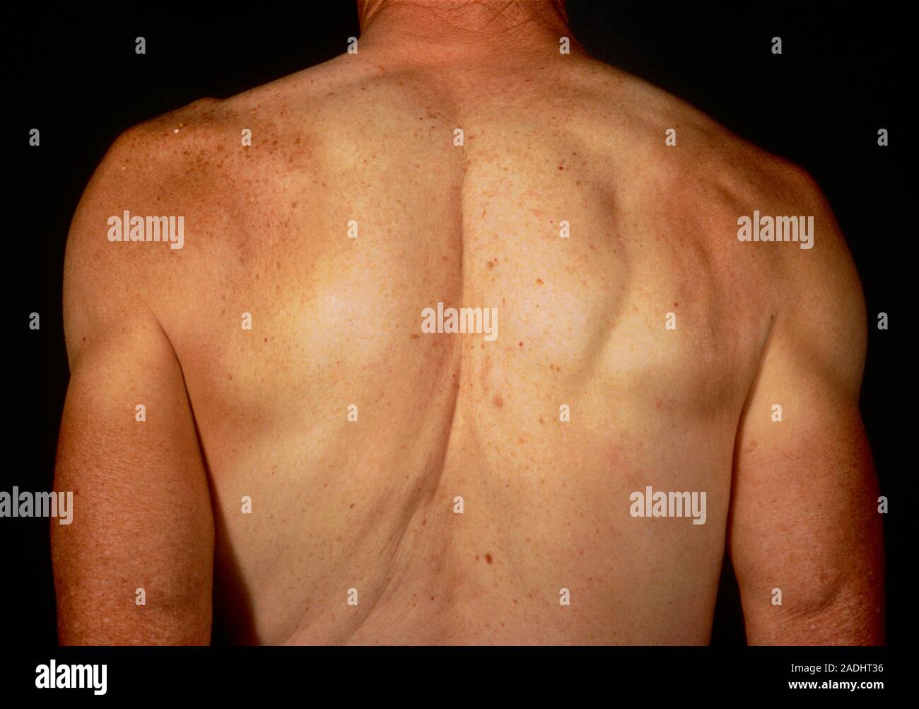 Man with a dislocated right shoulder, a common sports injury ...