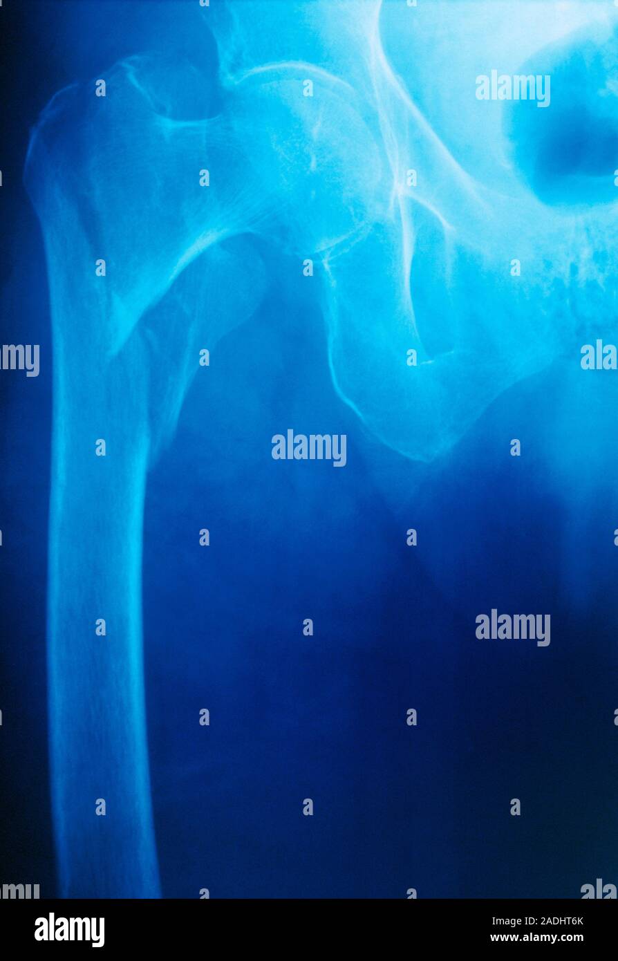 Hip fracture: X-ray image revealing a fracture of the neck of the left ...