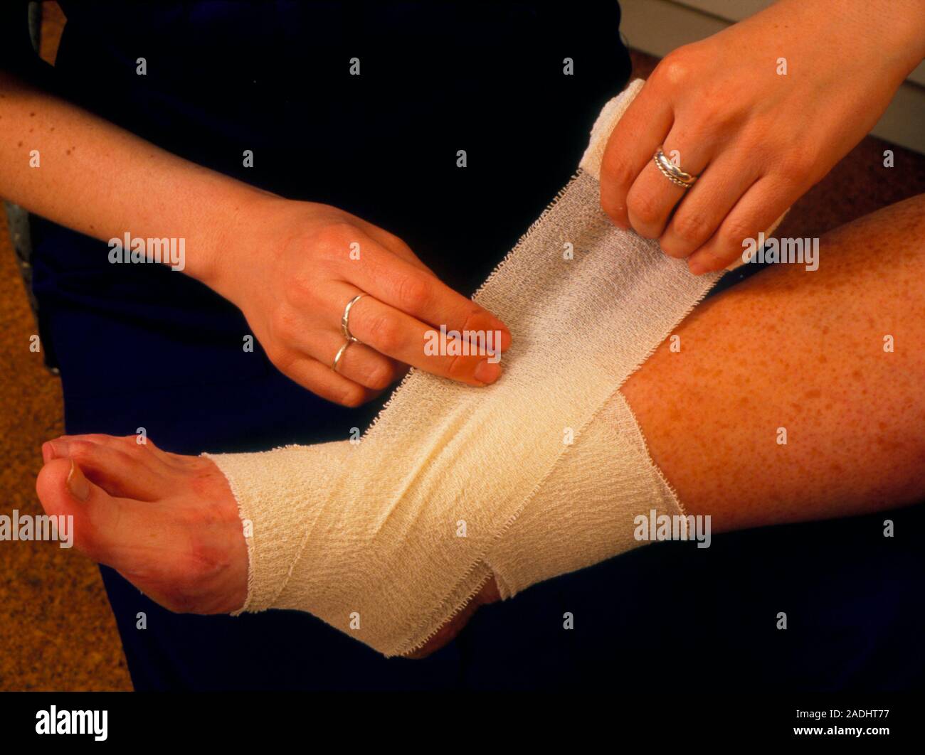 Nurse winding a crepe bandage around a sprained ankle. A sprain is an ...