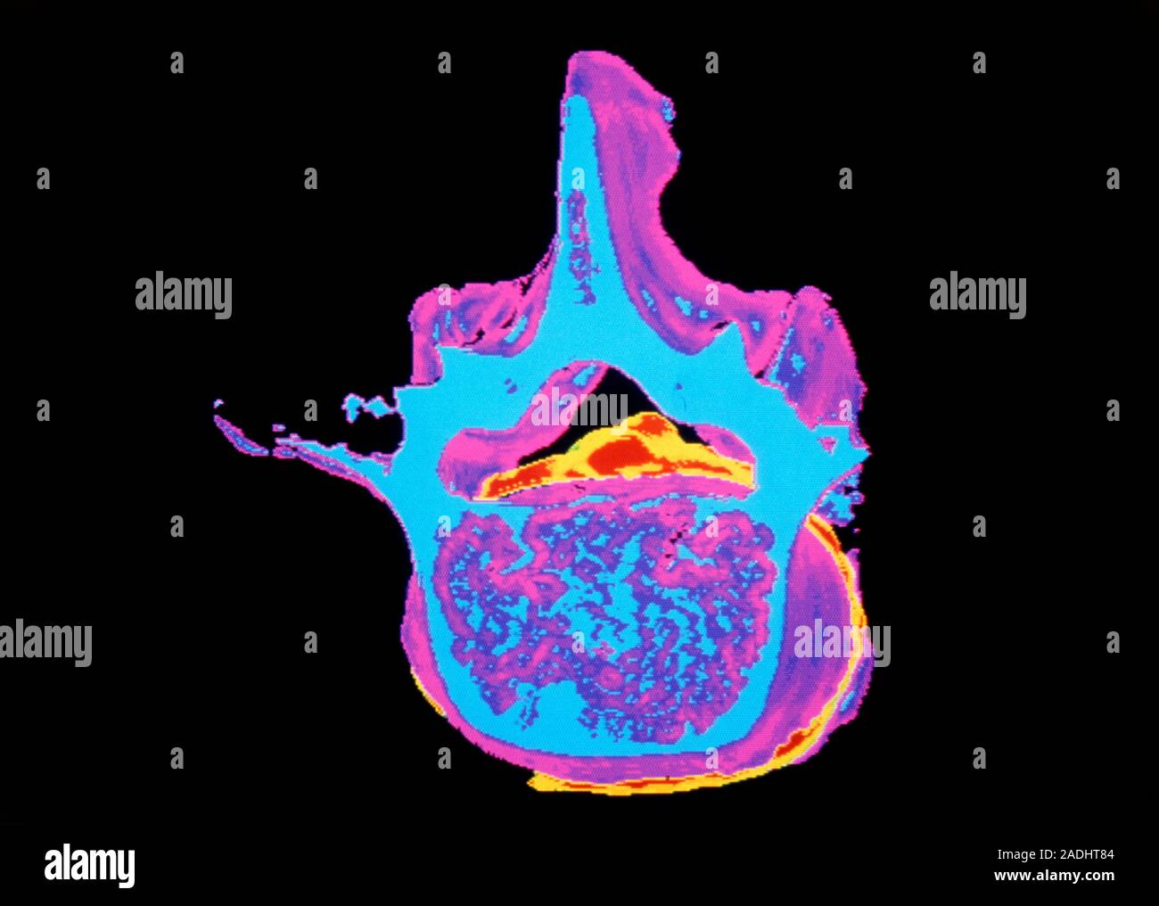 False-colour computed tomography (CT) scan of a slipped (prolapsed ...