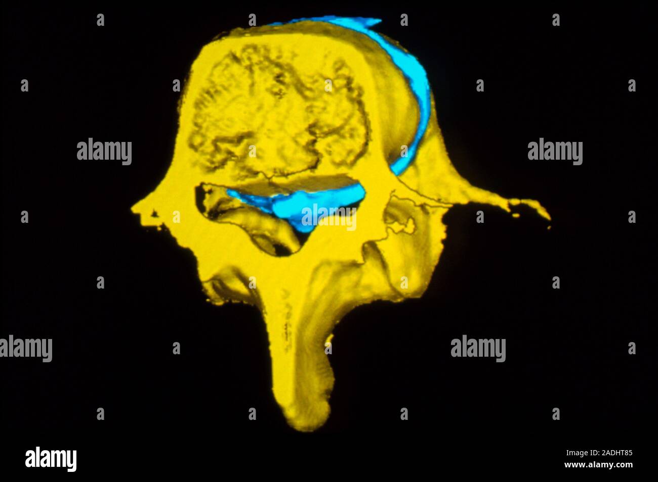 False-colour three-dimensional computed tomography (CT) scan of a ...