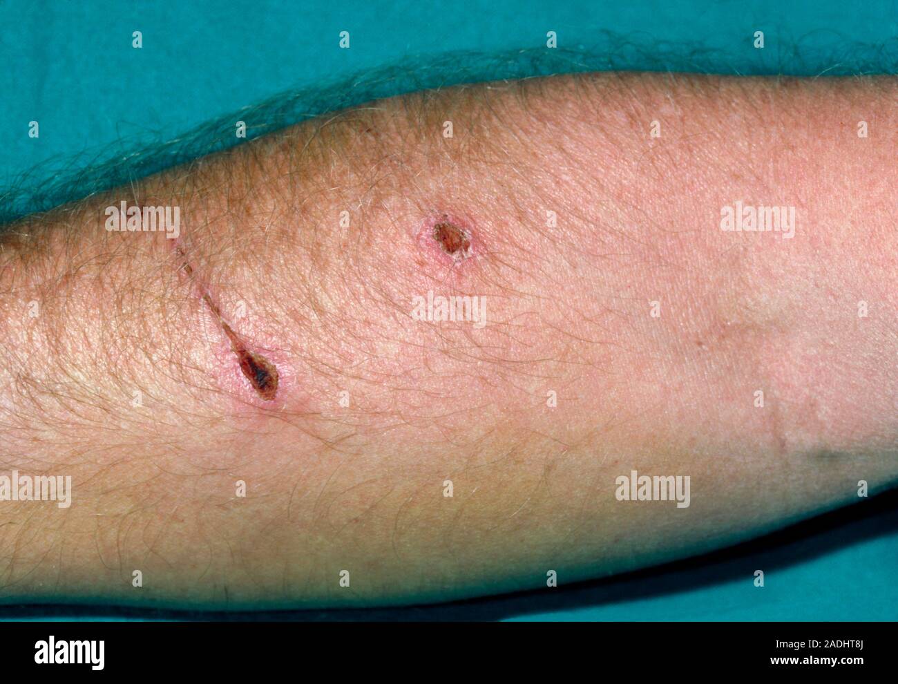 Dog bite. The scars of a dog bite one week after the injury took place ...