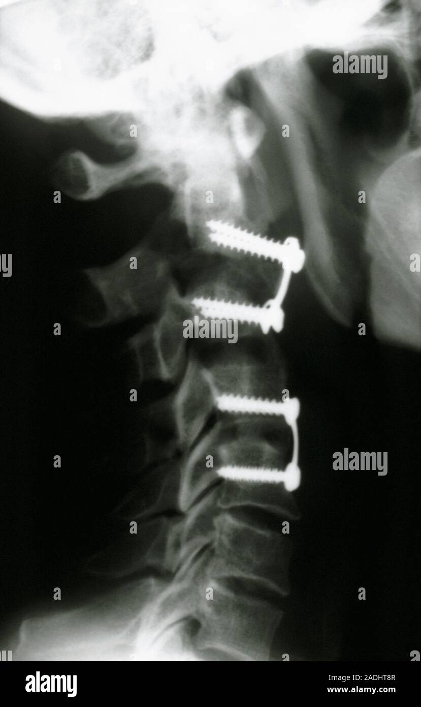 Neck fracture. X-ray of the vertebrae of the neck (side view) of a ...