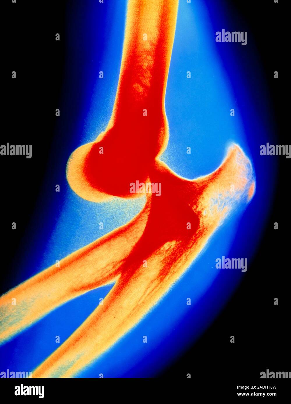 Coloured X-ray of a dislocation of the elbow joint, the ball & socket ...