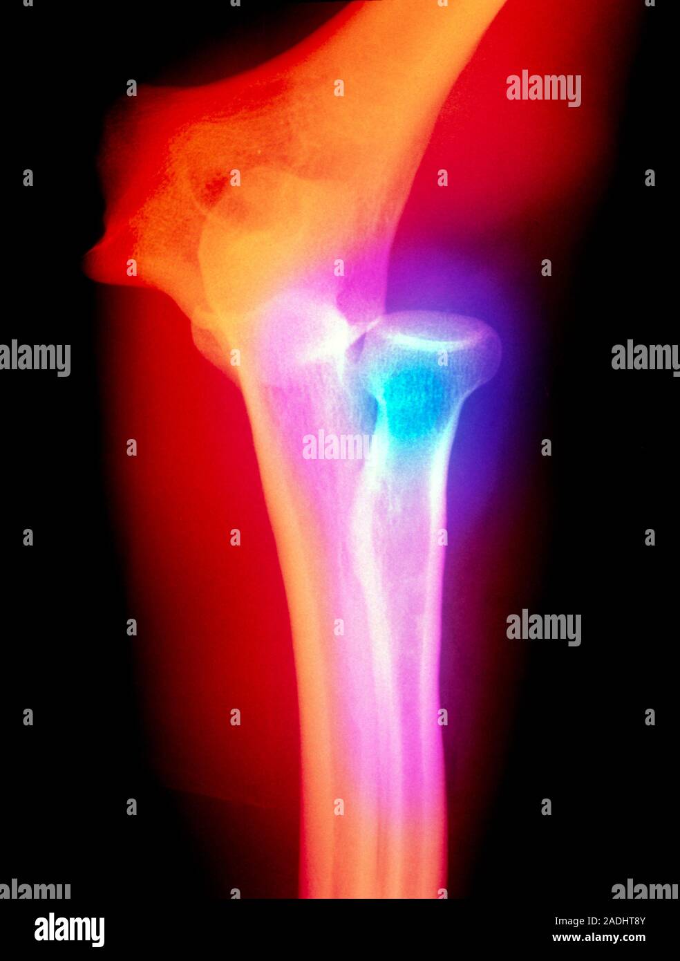 Coloured X-ray showing the dislocation of the elbow joint, the joint ...