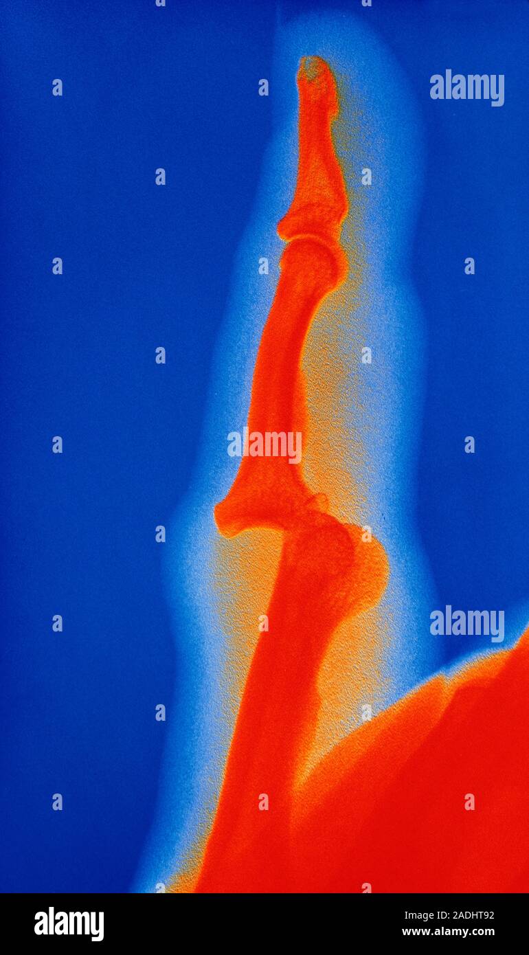 Dislocated finger. Coloured X-ray showing the dislocation between two ...