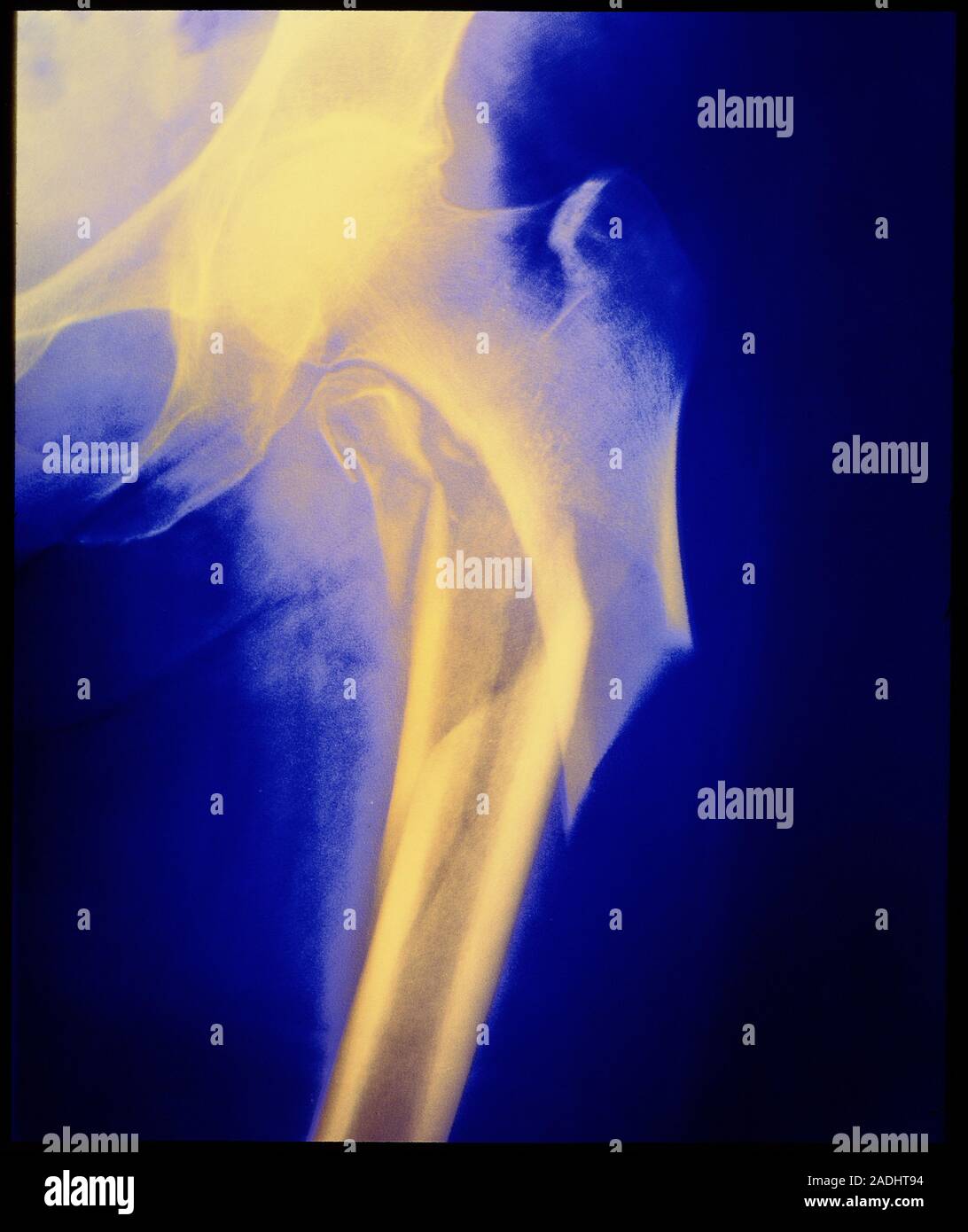 Broken thigh bone. Coloured X-ray image showing a compound fracture of ...