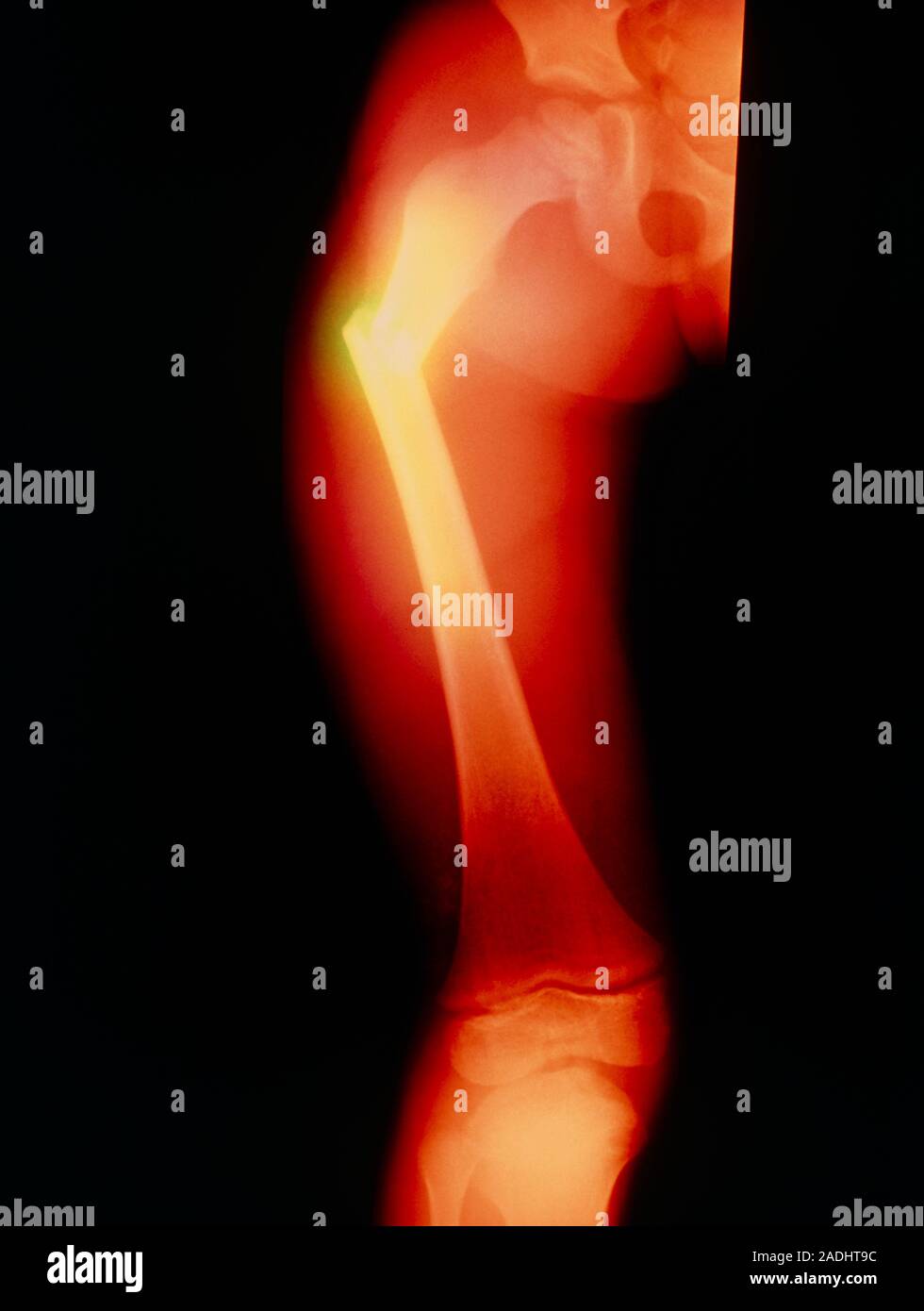 Broken thigh bone. Coloured X-ray image showing a fracture of a child's ...