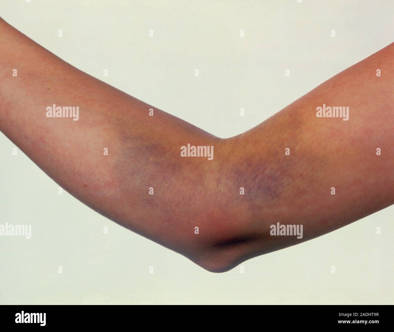 Bruising after a blood test. View of a woman's arm showing a large ...