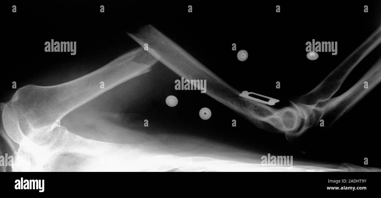 Broken upper armbone. X-ray image of a fractured humerus, the bone of ...