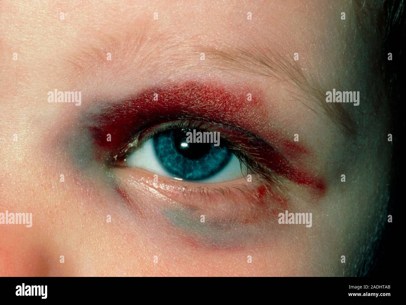Black eye. Close-up of extensive bruising around a child's left eye ...