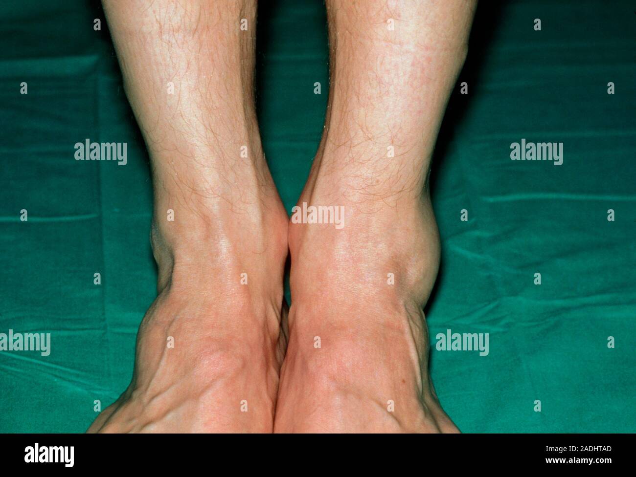 Sprained ankle. Swollen left ankle (at right) due to a sprain. A sprain ...