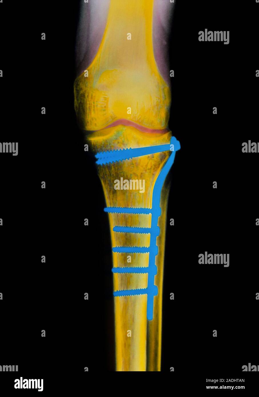 Fractured tibia. Coloured X-ray of metal pins holding a fractured tibia ...