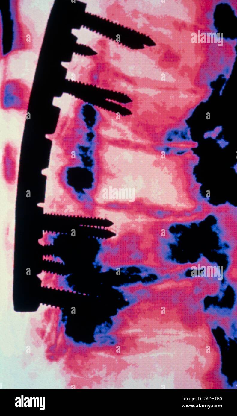 Fractured spine. Coloured X-ray of a fractured human spine splinted ...
